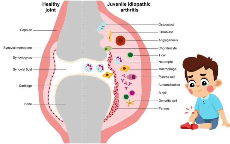 Ayurvedic Treatment For Juvenile Idiopathic Arthritis